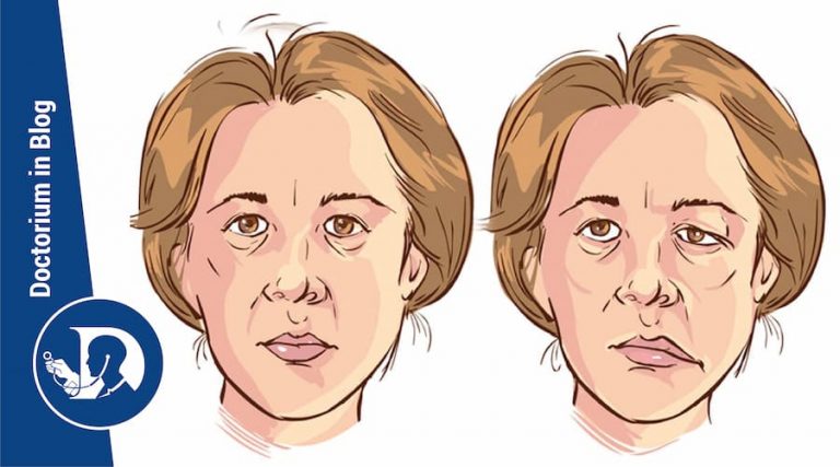 Paralisi di Bell: cos’è, cause, sintomi e trattamento | doctorium.it