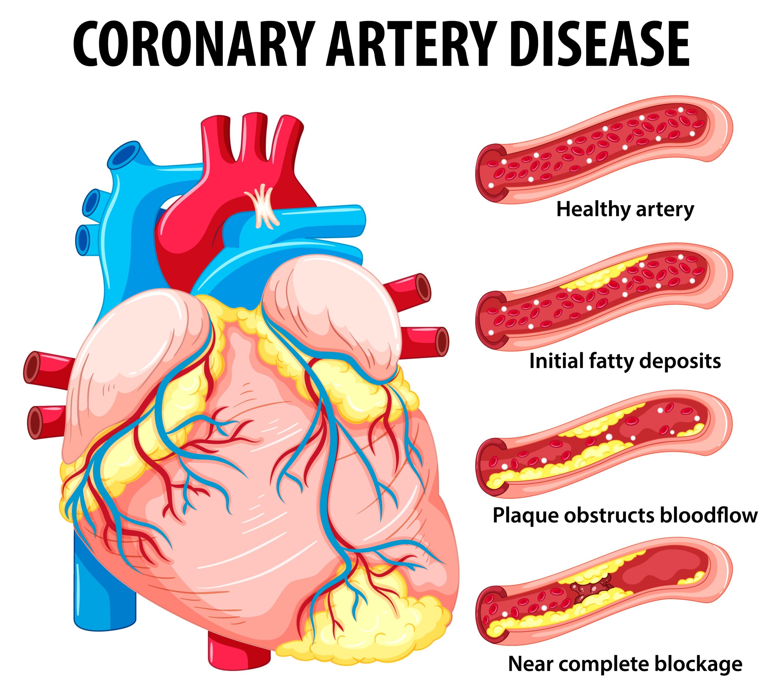 Infarto Miocardico Acuto - Doctorium